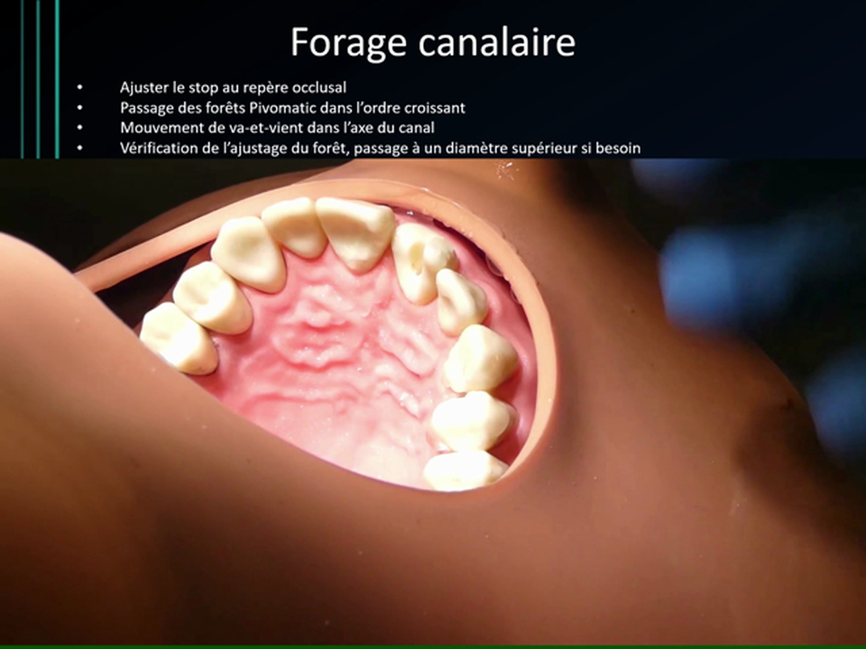 Lille.Pod - Inlay-Core - Montage En Méthode Directe